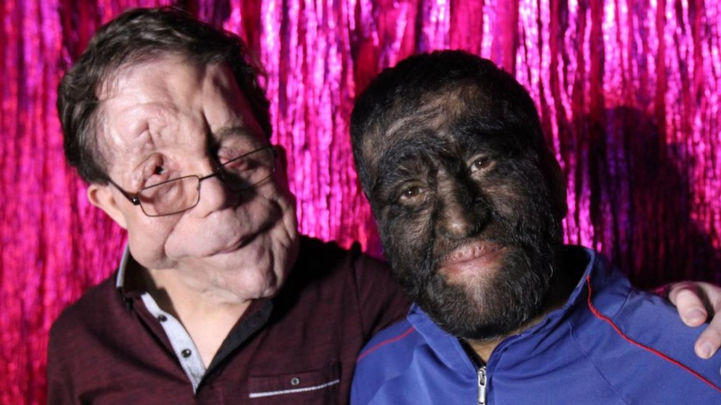 'You are the modern day Elephant Man' - BBC News