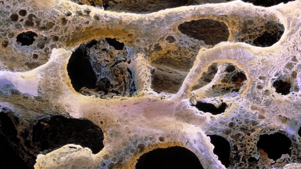 Protein Could Bring Hope To Brittle Bone Disease BBC News