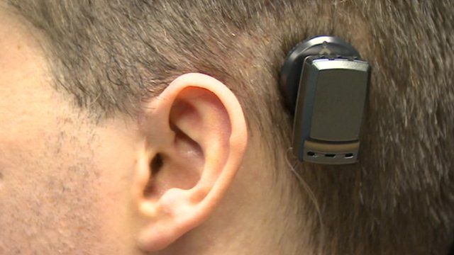 Magnetic implants fitted for hearing loss patients - BBC News