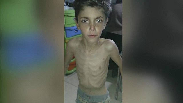 El horror que viven los niños desnutridos en Siria - BBC Mundo